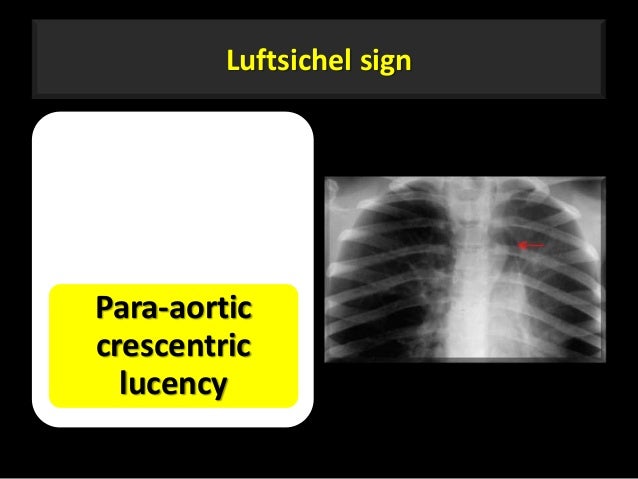 A pictorial review of “signs in thoracic imaging 02”