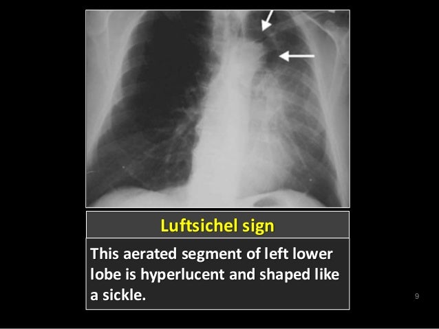 A pictorial review of “signs in thoracic imaging 02”