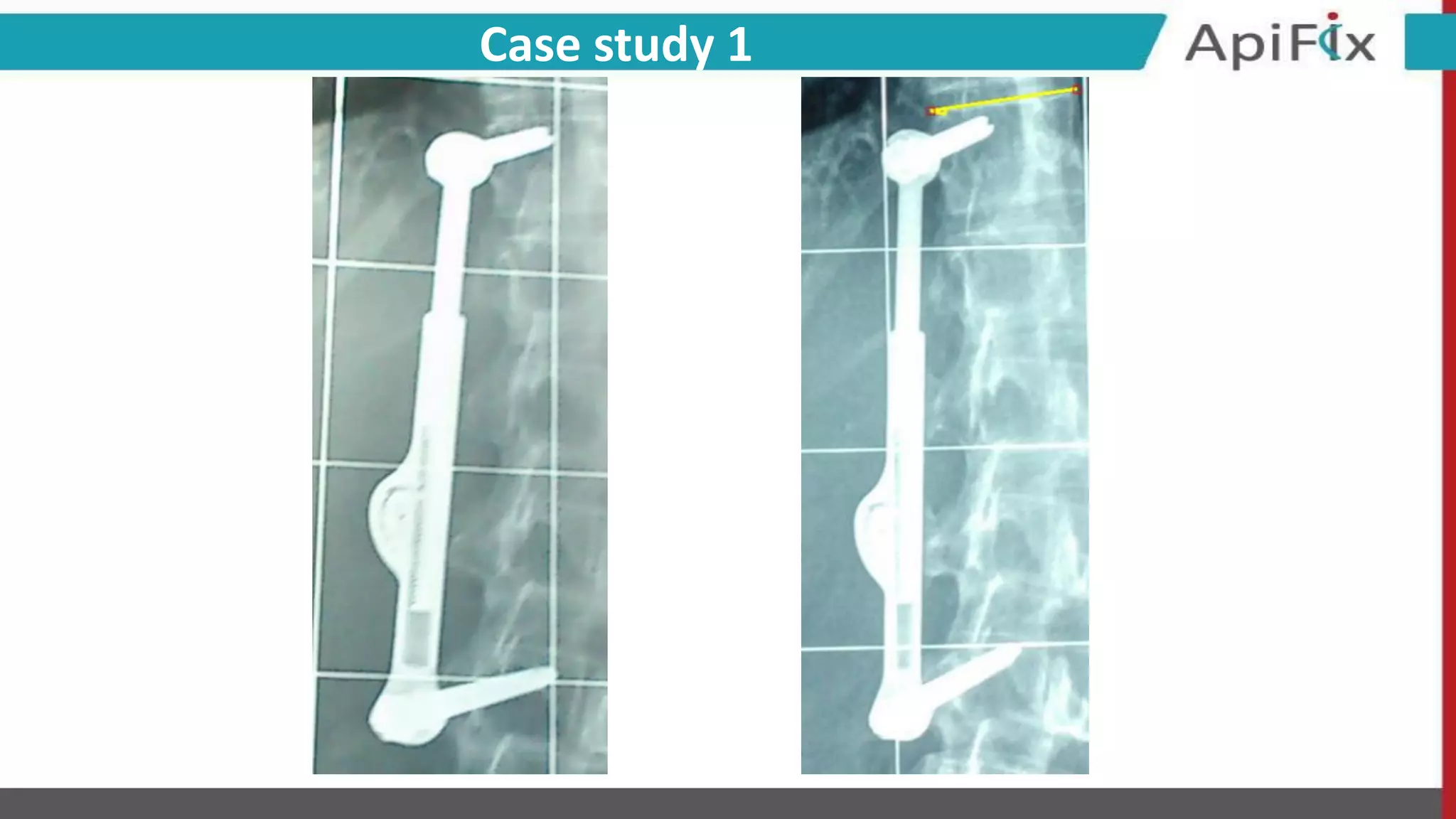 ApiFix treatment for Adolescent Idiopathic Scoliosis (AIS): The ...