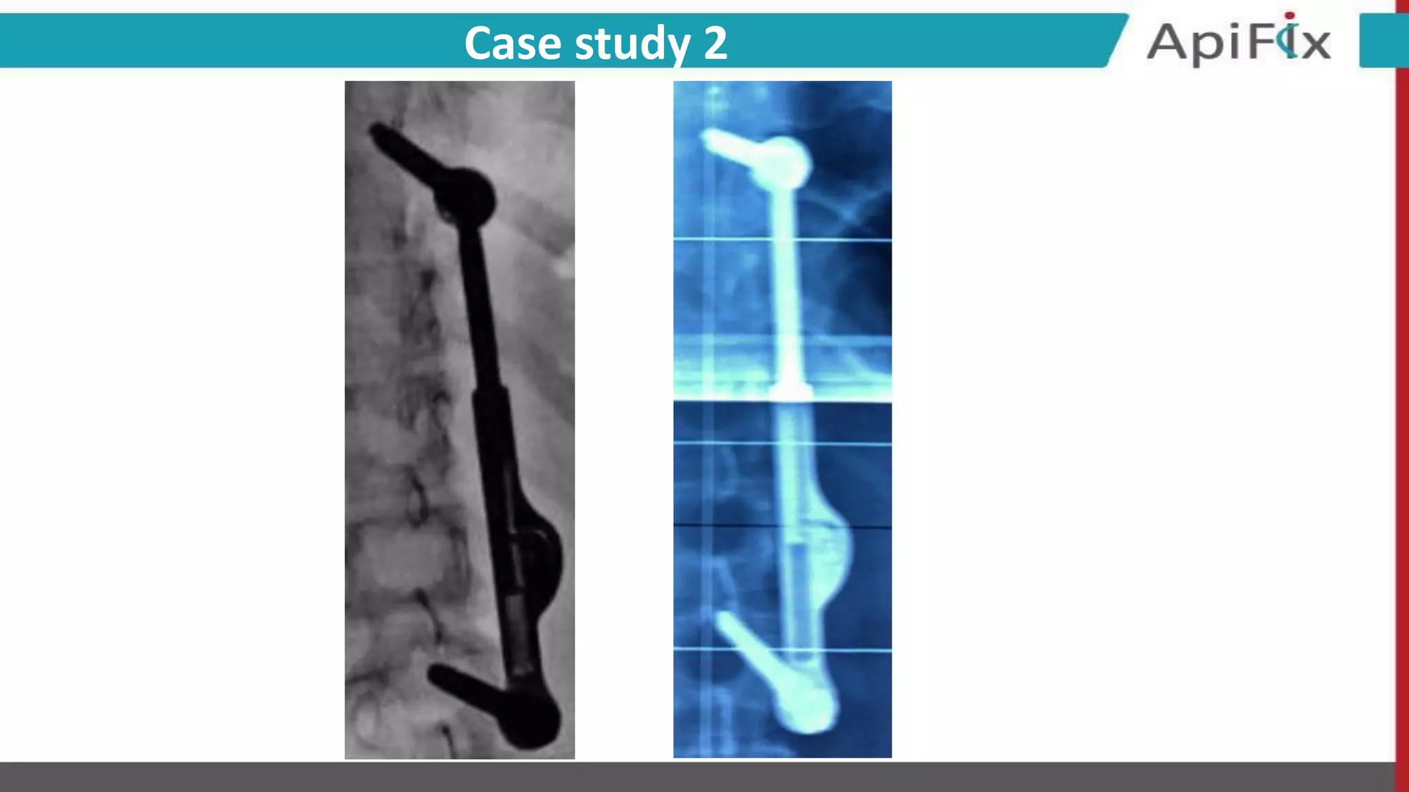 ApiFix treatment for Adolescent Idiopathic Scoliosis (AIS): The ...