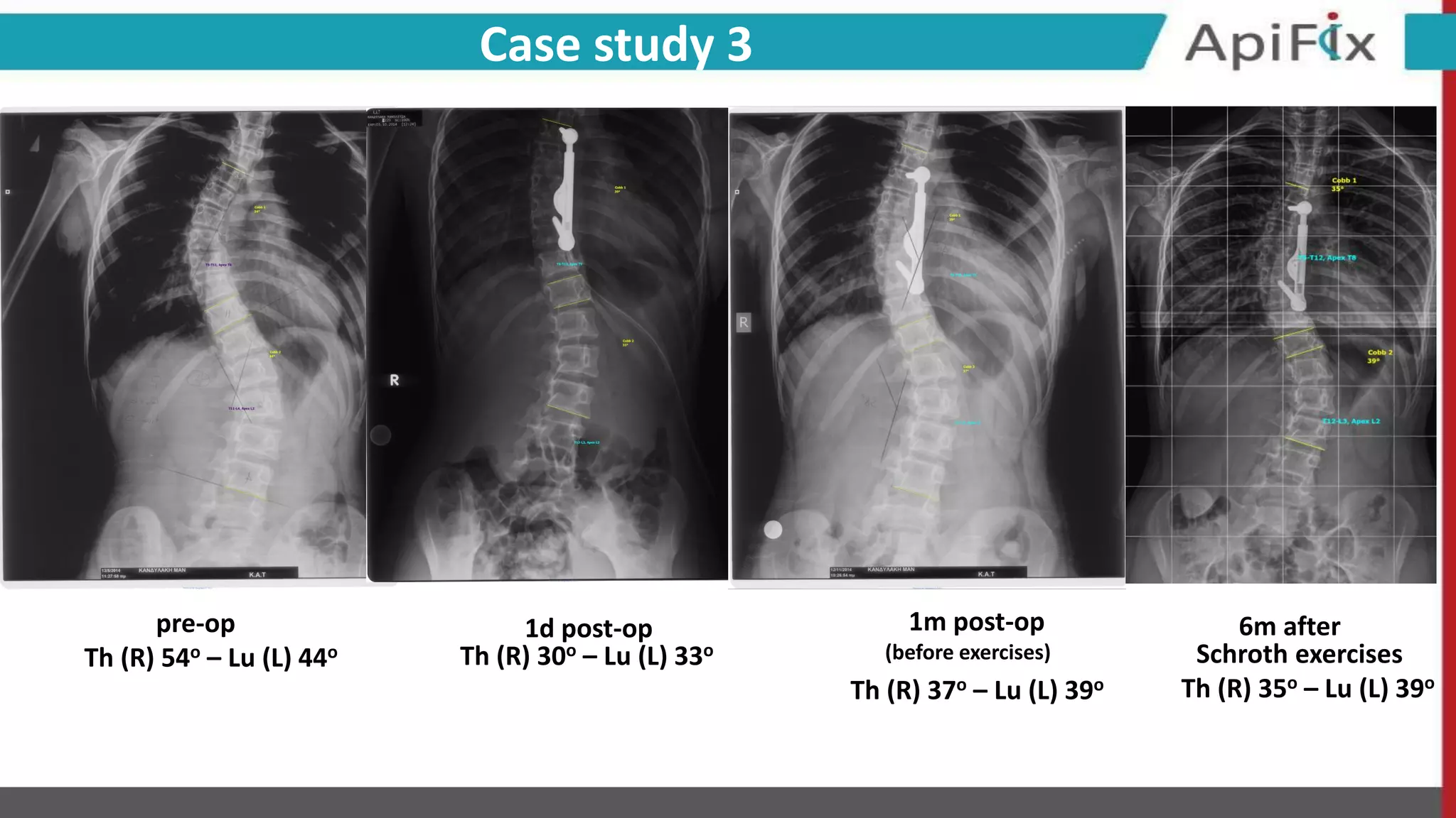 ApiFix treatment for Adolescent Idiopathic Scoliosis (AIS): The ...