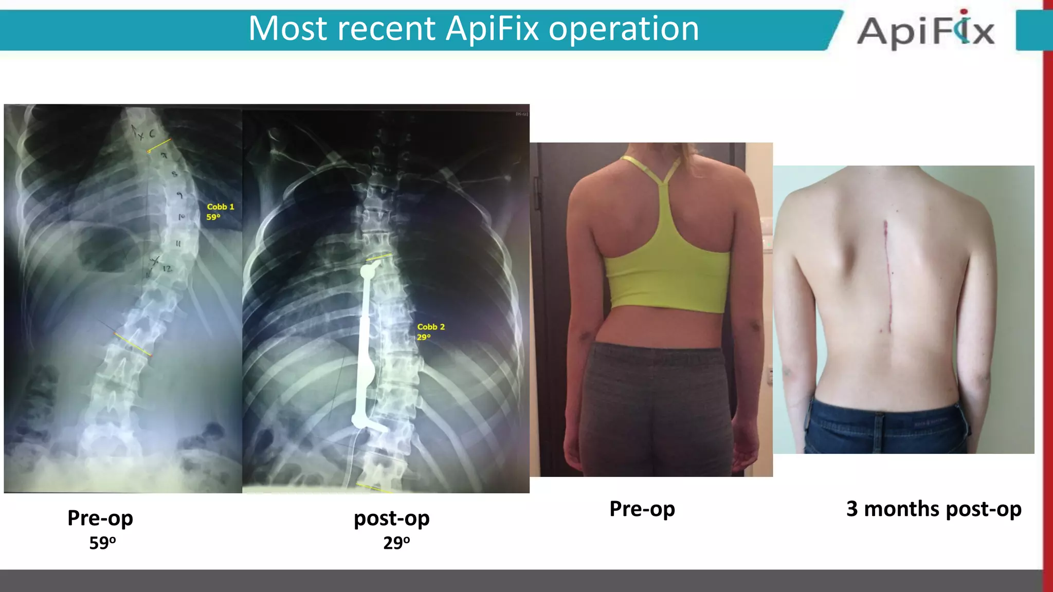 ApiFix treatment for Adolescent Idiopathic Scoliosis (AIS): The ...