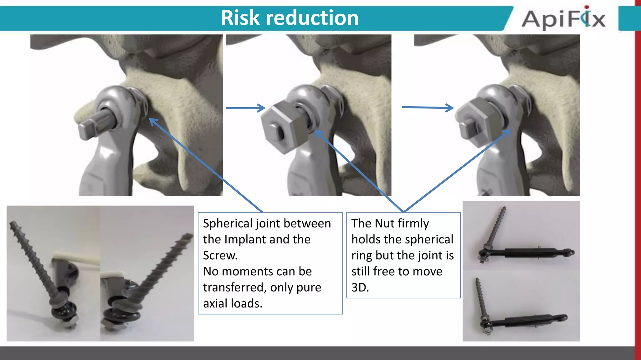 ApiFix treatment for Adolescent Idiopathic Scoliosis (AIS): The ...
