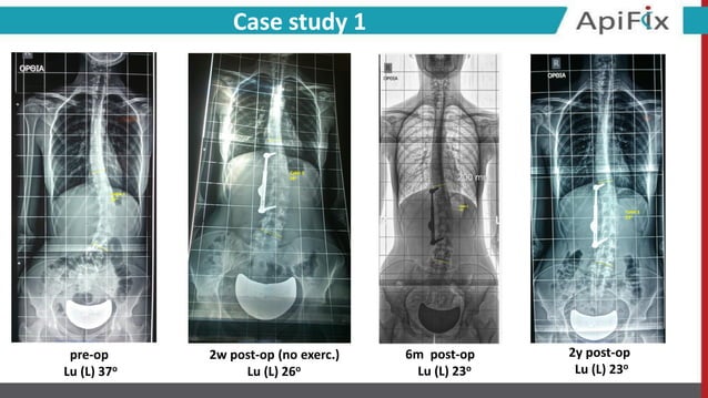 ApiFix treatment for Adolescent Idiopathic Scoliosis (AIS): The ...