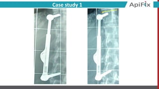 ApiFix treatment for Adolescent Idiopathic Scoliosis (AIS): The ...