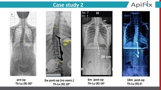 ApiFix treatment for Adolescent Idiopathic Scoliosis (AIS): The ...