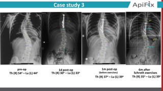 ApiFix treatment for Adolescent Idiopathic Scoliosis (AIS): The ...