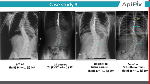 ApiFix treatment for Adolescent Idiopathic Scoliosis (AIS): The ...