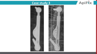 ApiFix treatment for Adolescent Idiopathic Scoliosis (AIS): The ...