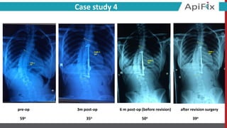 ApiFix treatment for Adolescent Idiopathic Scoliosis (AIS): The ...