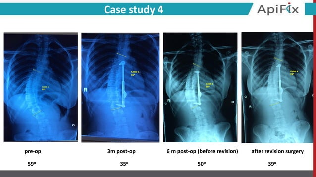 ApiFix treatment for Adolescent Idiopathic Scoliosis (AIS): The ...