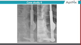 ApiFix treatment for Adolescent Idiopathic Scoliosis (AIS): The ...