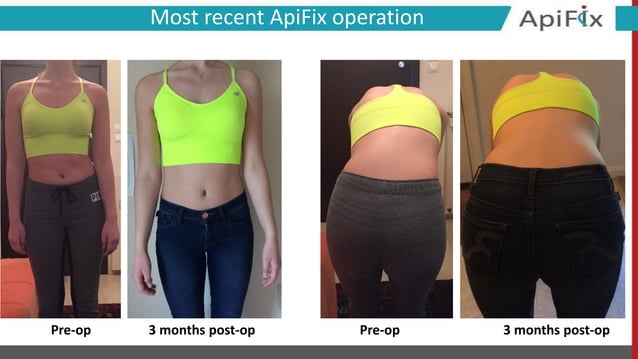 ApiFix treatment for Adolescent Idiopathic Scoliosis (AIS): The ...