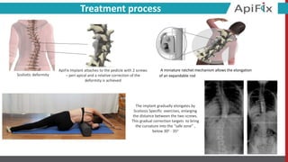 ApiFix treatment for Adolescent Idiopathic Scoliosis (AIS): The ...
