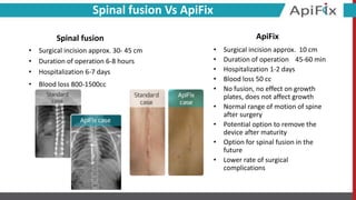 ApiFix treatment for Adolescent Idiopathic Scoliosis (AIS): The ...