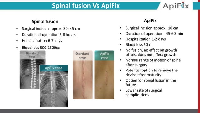 ApiFix treatment for Adolescent Idiopathic Scoliosis (AIS): The ...