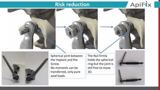 ApiFix treatment for Adolescent Idiopathic Scoliosis (AIS): The ...