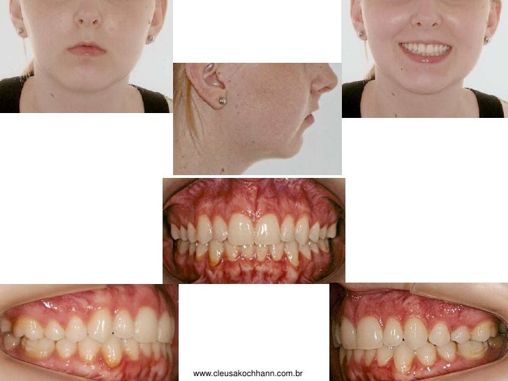 Apinhamento Anterior