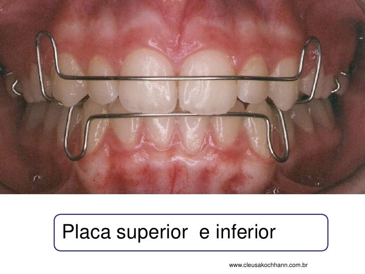 Apinhamento Anterior