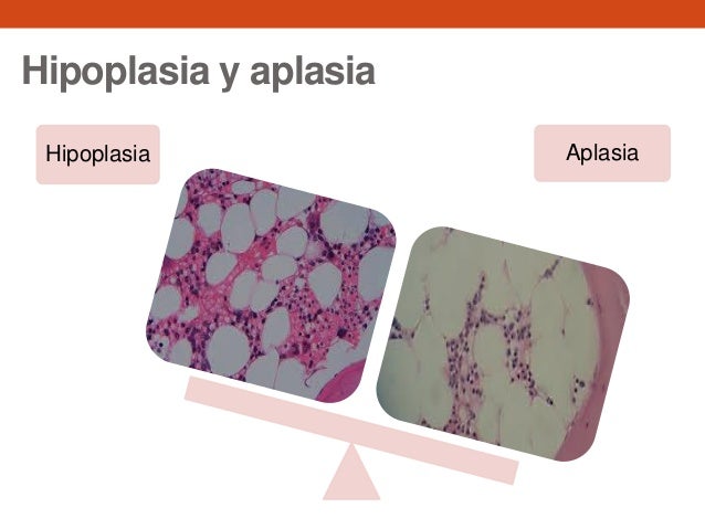 Aplasia medular