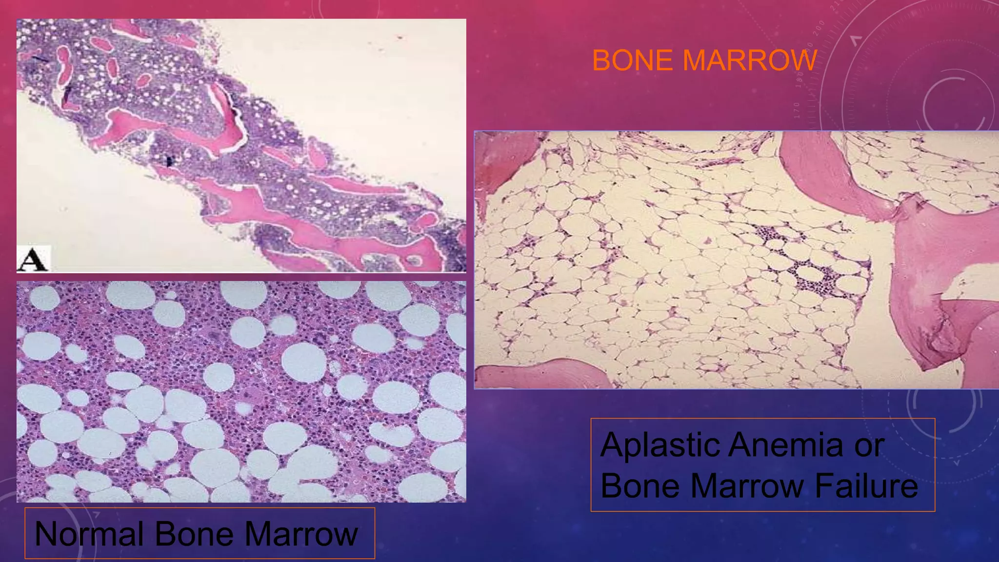 Aplastic anemia | PPSX