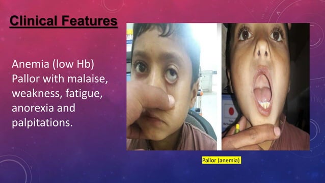 Aplastic anemia | PPSX | Blood Disorders | Diseases and Conditions