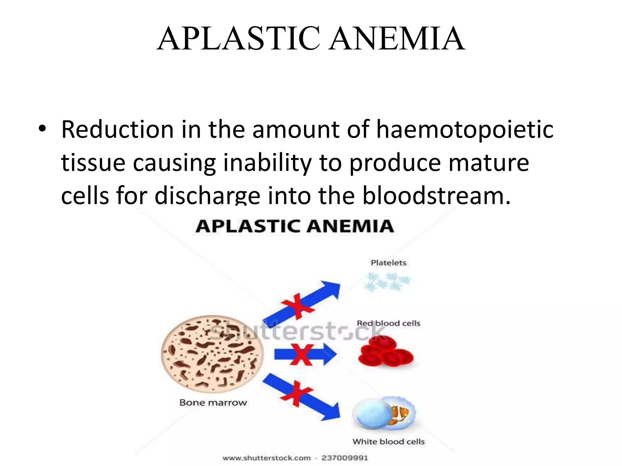 Aplastic anaemia | PPTX