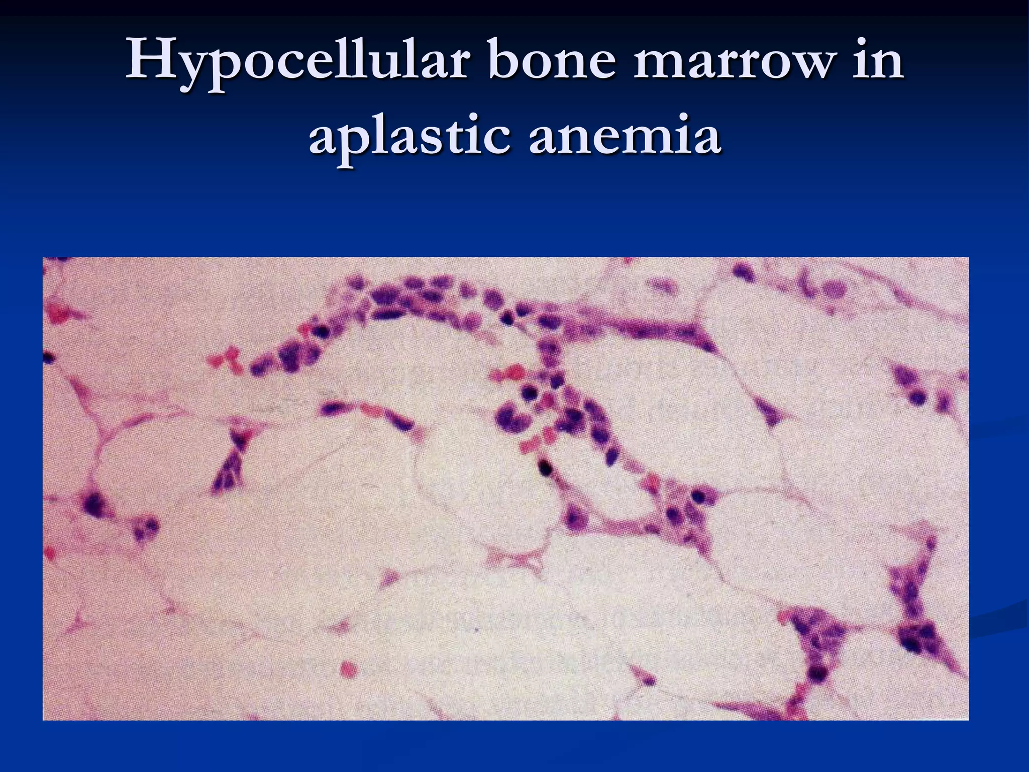 Aplastic and hypoproliferative anemias | PPTX
