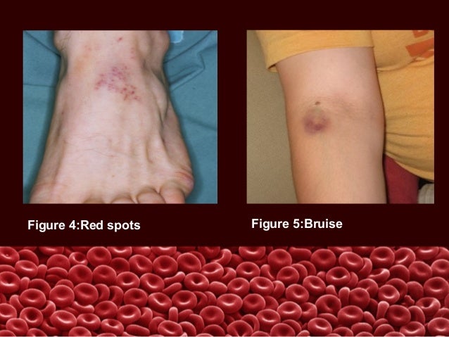 Aplastic anemia