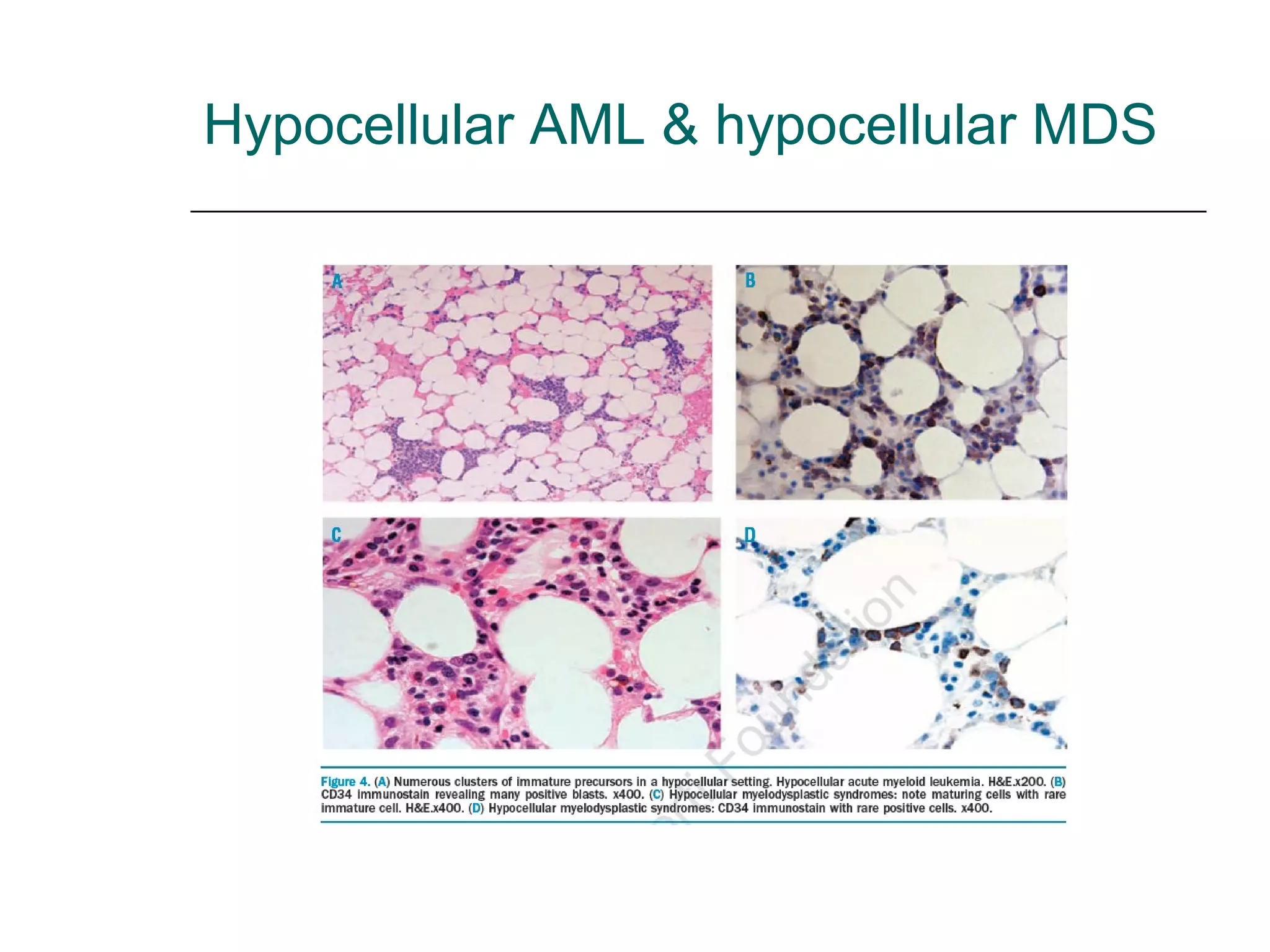 Aplastic anemia | PPT