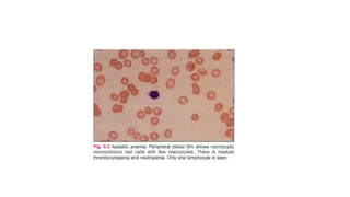 APLASTIC ANEMIA - chronic primary hematopoietic stem cell (HSC ...