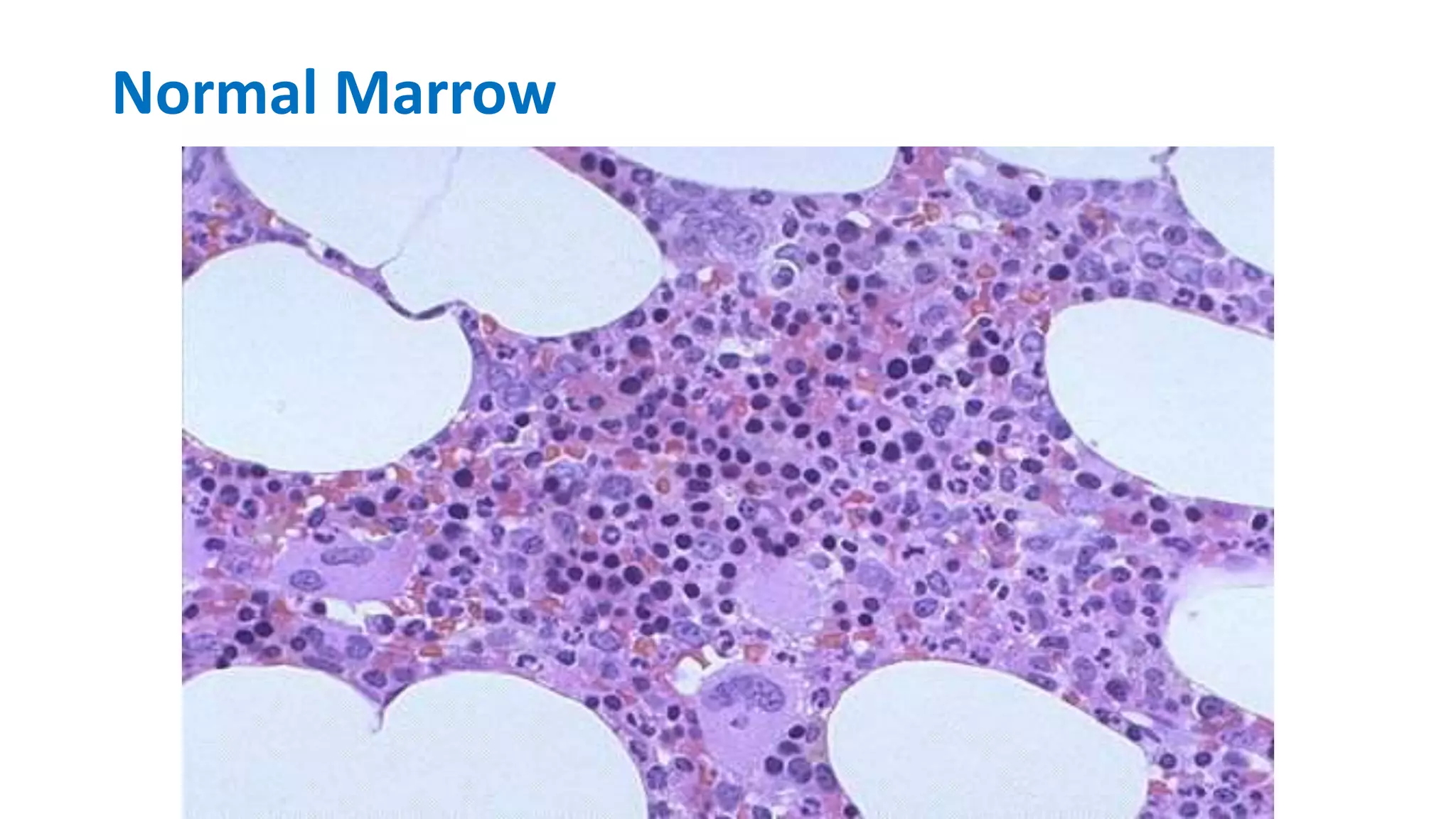 Aplastic Anemias & Bone Marrow Transplant I by Dr. Sookun Rajeev Kumar ...