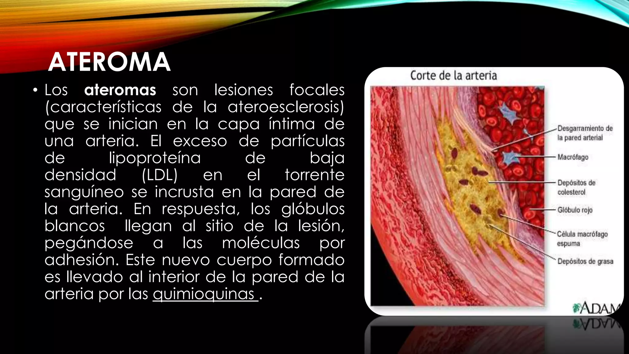 Ateroma, Aterosclerosis, ceto-acidosis diabetica, Enfermedad de gaucher ...