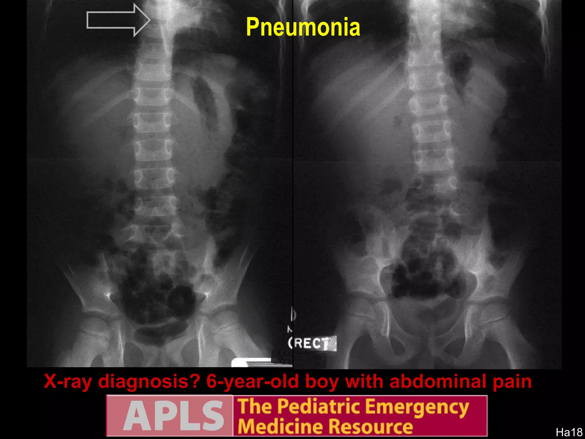 Apls Pediatric Emergency Radiology 1 | PPT