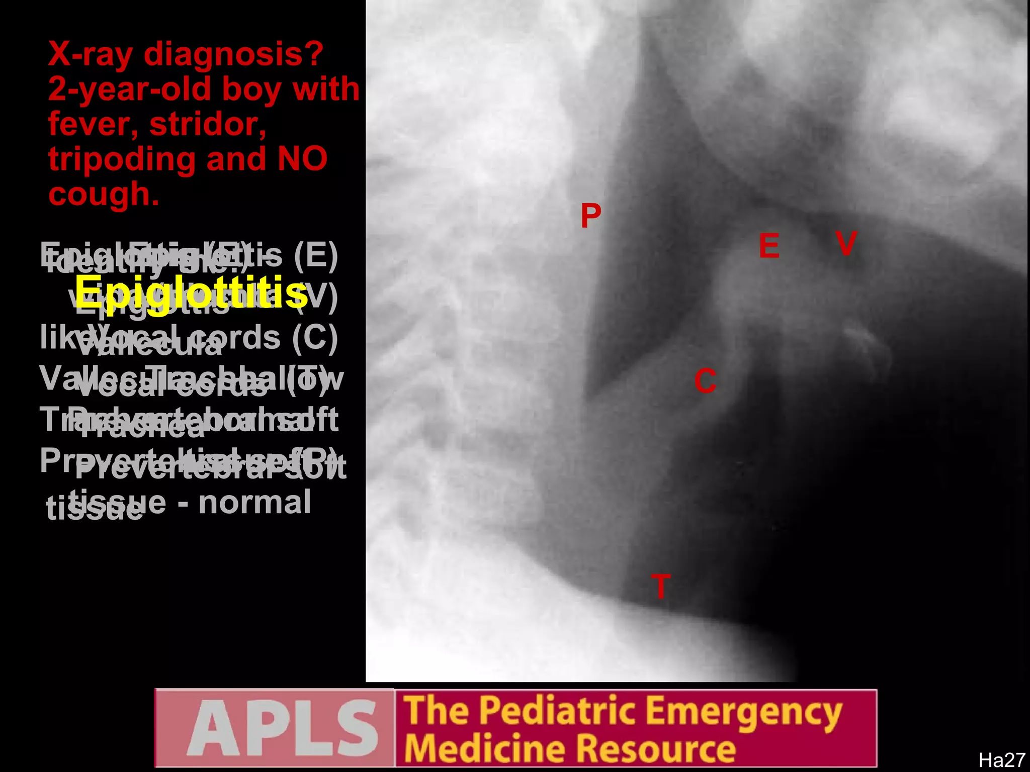 Apls Pediatric Emergency Radiology 1 | PPT