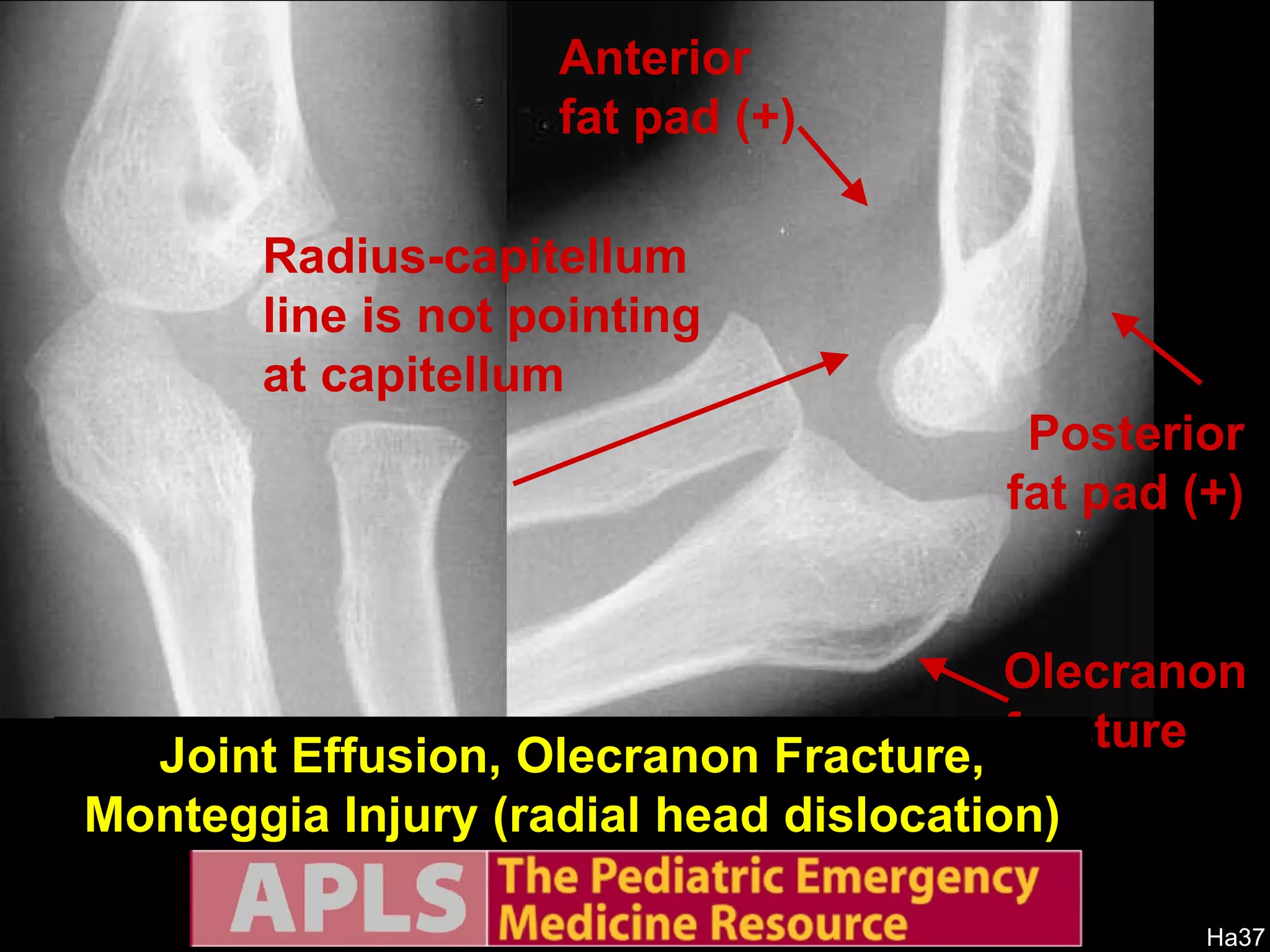 Apls Pediatric Emergency Radiology 1 | PPT