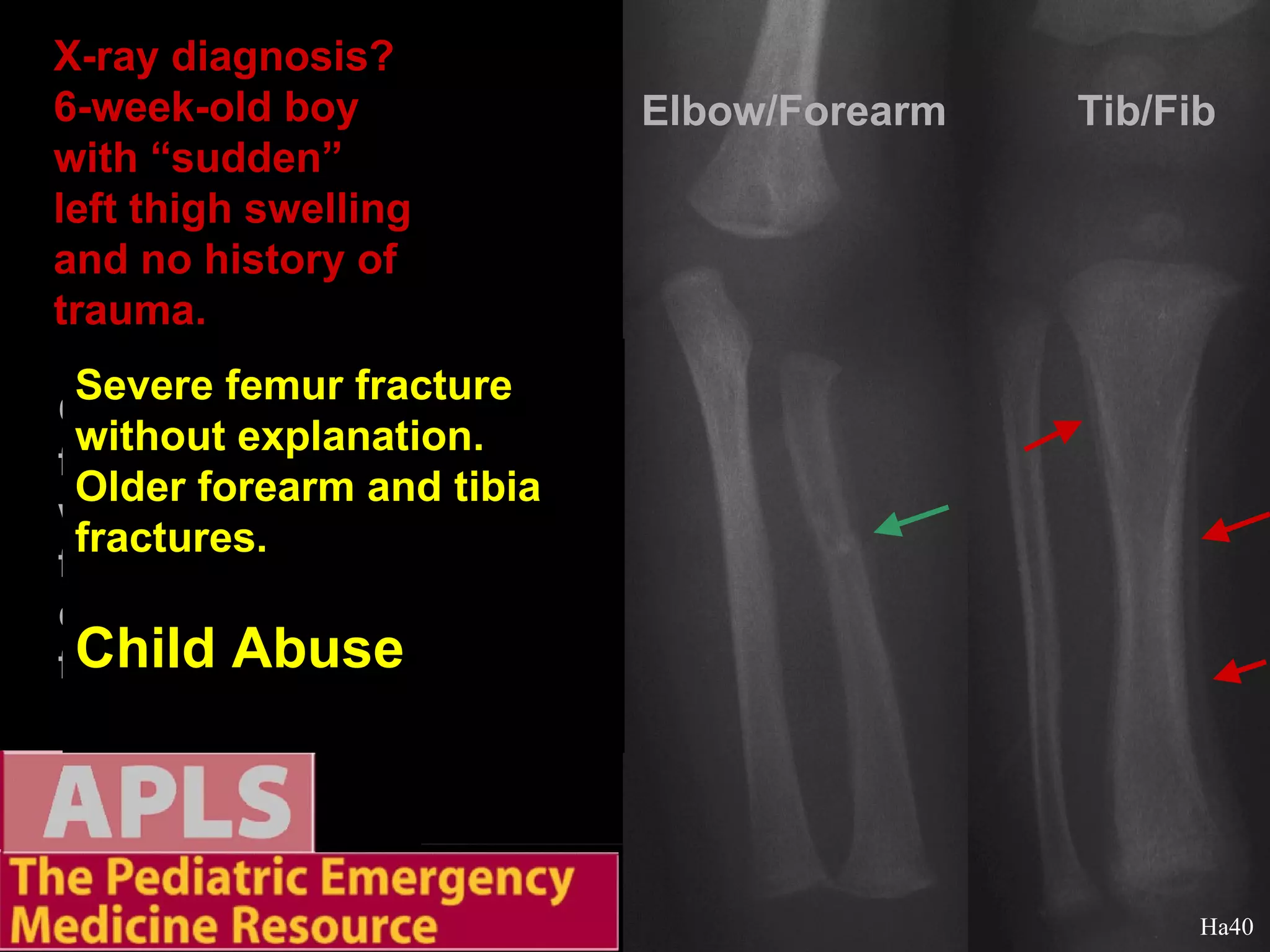 Apls Pediatric Emergency Radiology 1 | PPT