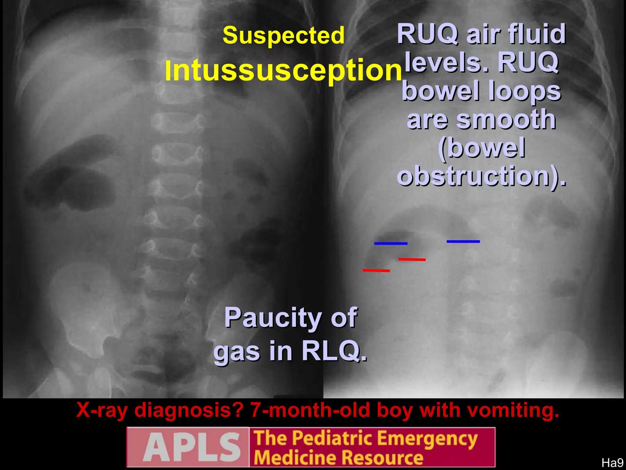 Apls Pediatric Emergency Radiology 1 | PPT