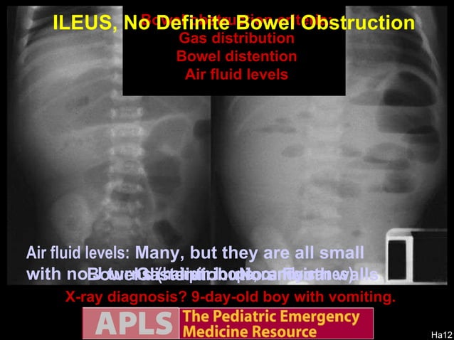 Apls Pediatric Emergency Radiology 1 | PPT | Death, Injury, or Military ...