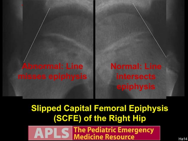 Apls Pediatric Emergency Radiology 1 | PPT | Death, Injury, or Military ...