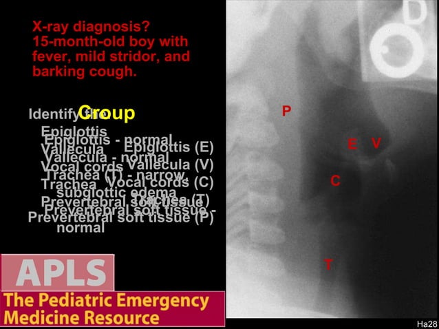 Apls Pediatric Emergency Radiology 1 | PPT | Death, Injury, or Military ...