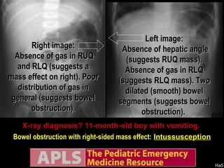 Apls Pediatric Emergency Radiology 1 | PPT
