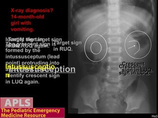 Crescent Sign Intussusception