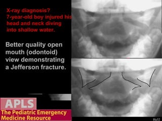 Jefferson Fracture Odontoid View