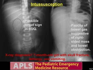 Intussusception X Ray