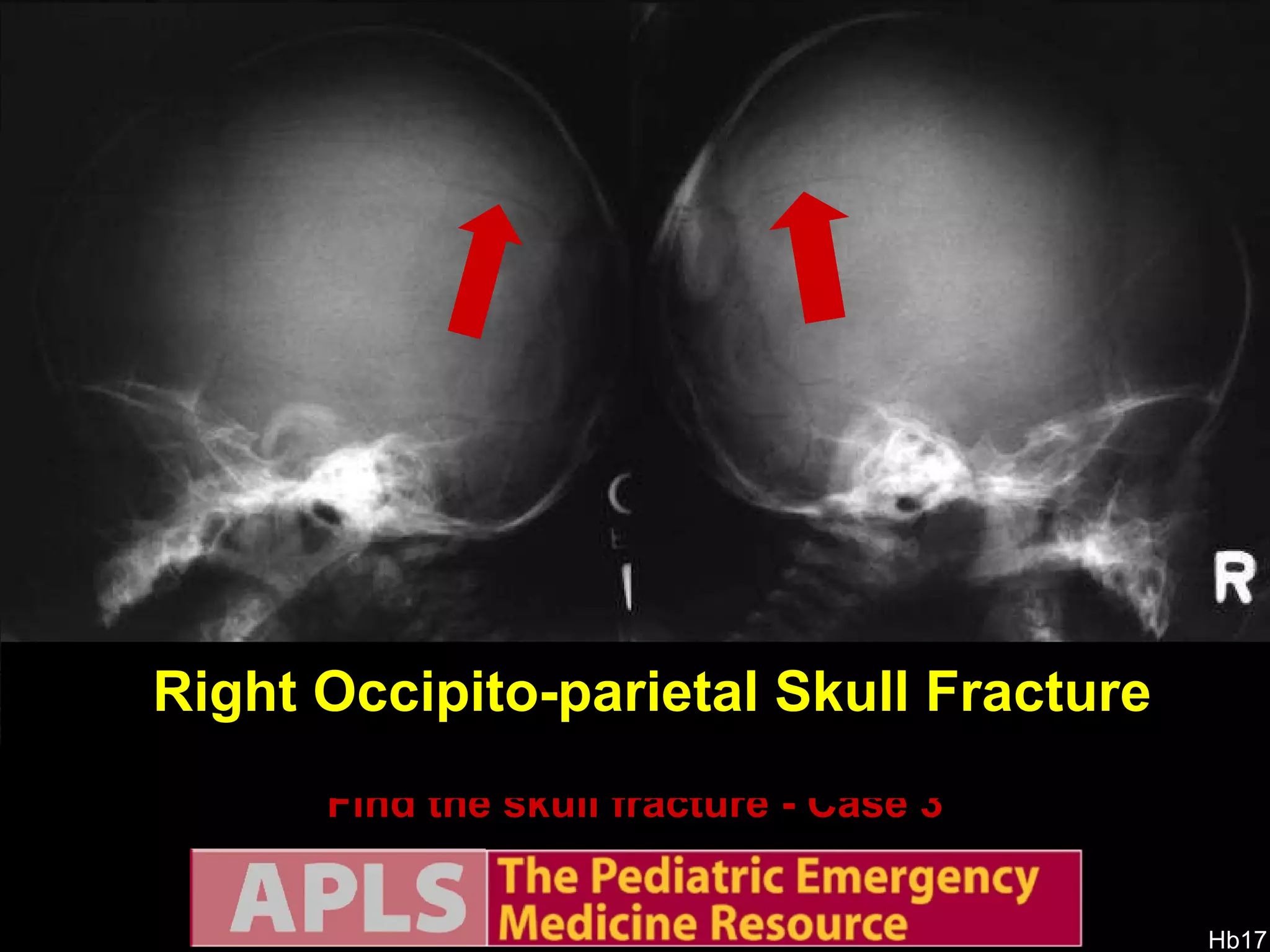 Apls Pediatric Emergency Radiology 2 | PPT