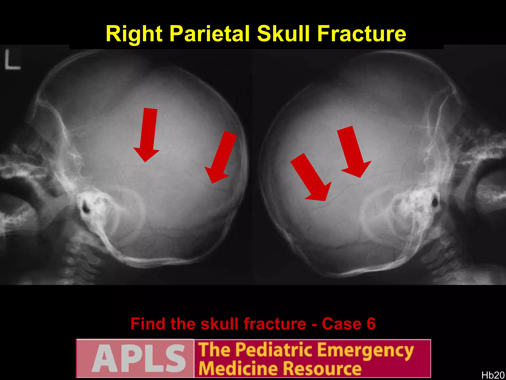 Apls Pediatric Emergency Radiology 2 | PPT