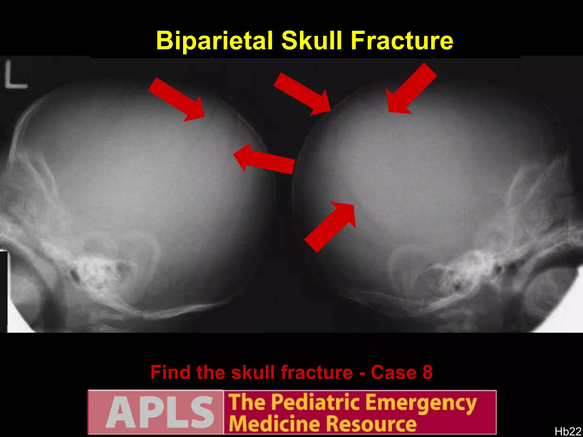 Apls Pediatric Emergency Radiology 2 | PPT
