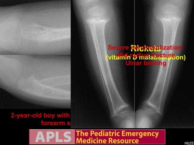 Apls Pediatric Emergency Radiology 2 | PPT