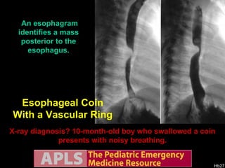 Apls Pediatric Emergency Radiology 2 | PPT